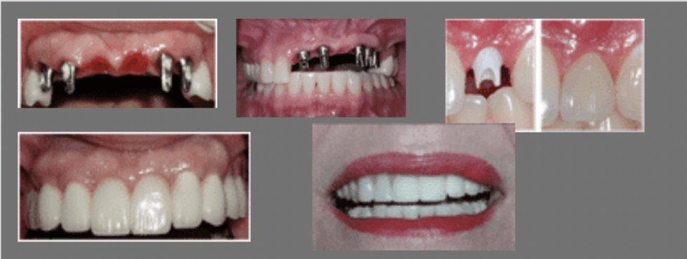 Designing Aesthetic & Functional Partial Dentures | Esthetic Professionals